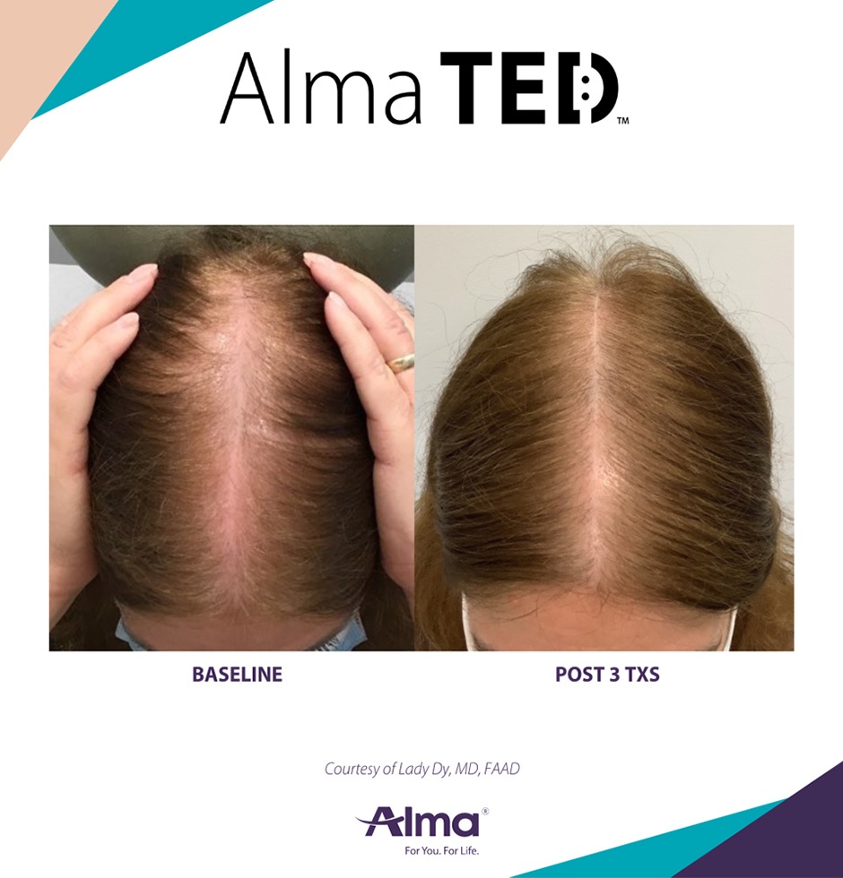 Alma TED Laser Hair Restoration for Women at HT&RC