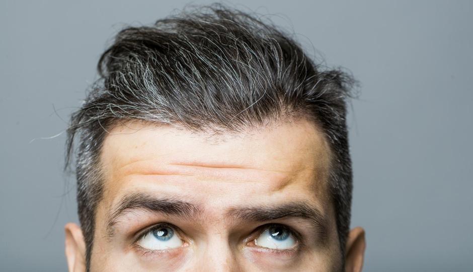 Links between androgenic alopecia and other diseases